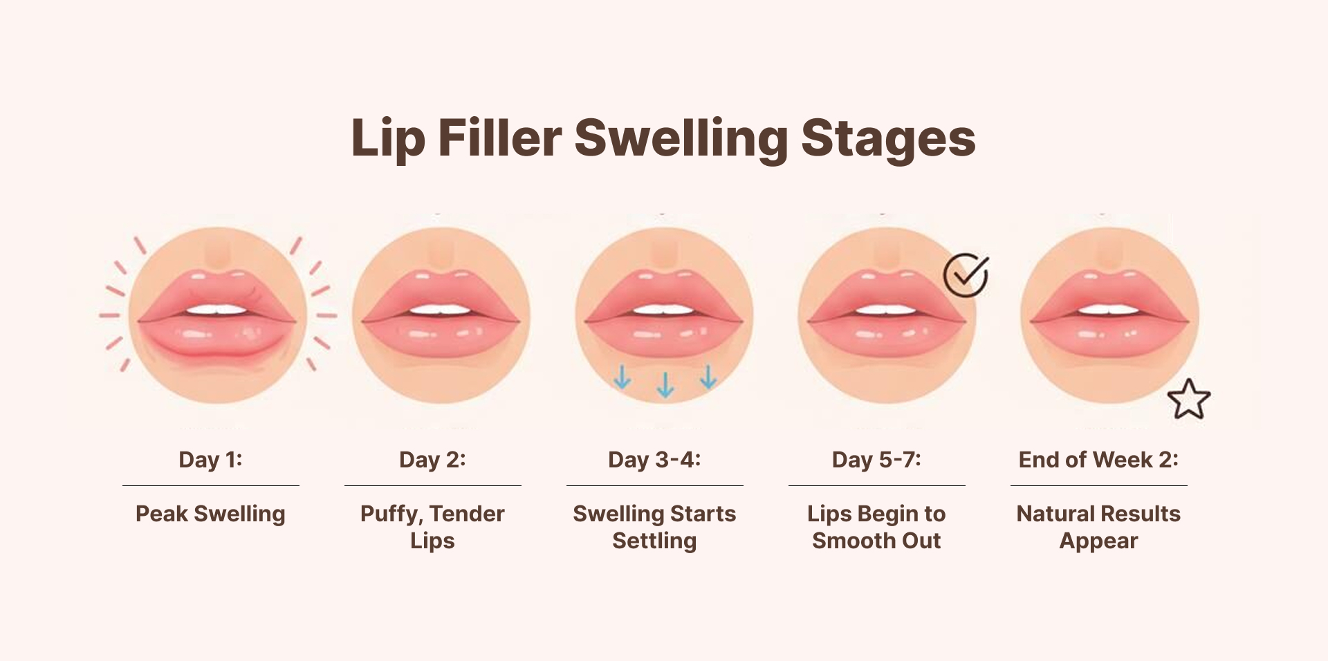 Lip Filler Swelling Stages: Day-by-Day Healing Guide