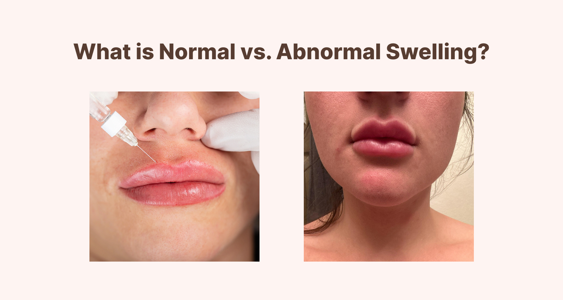 Lip Filler Swelling Stages: Day-by-Day Healing Guide
